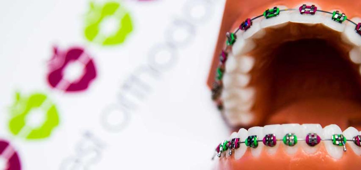 Invisalign vs Braces at Pinecrest Orthodontics in Miami | Rothman